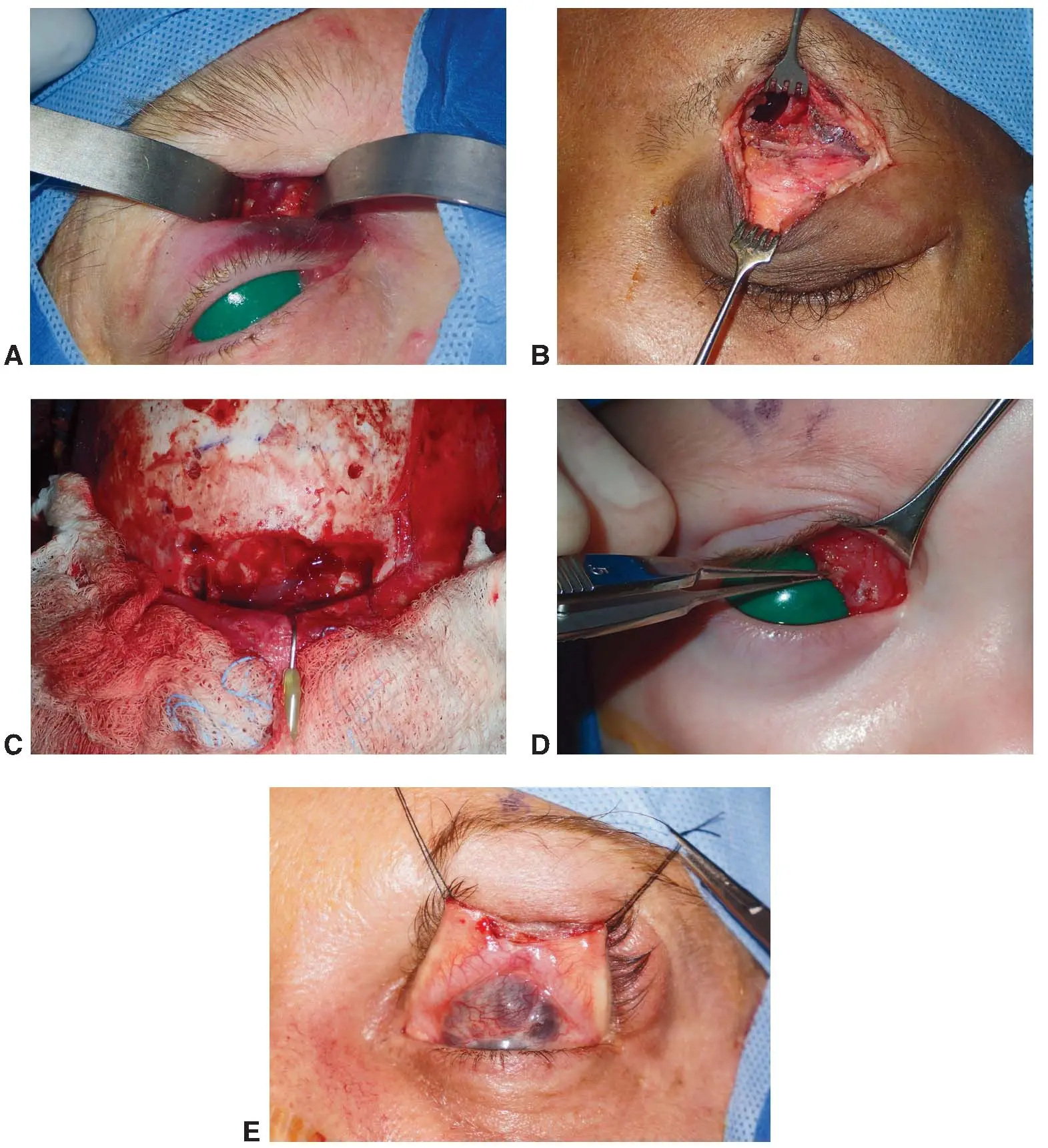 Superior Orbitotomy American Academy Of Ophthalmology