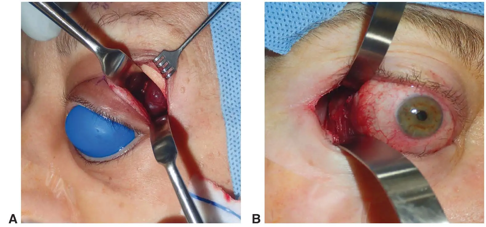Lateral Orbitotomy American Academy Of Ophthalmology