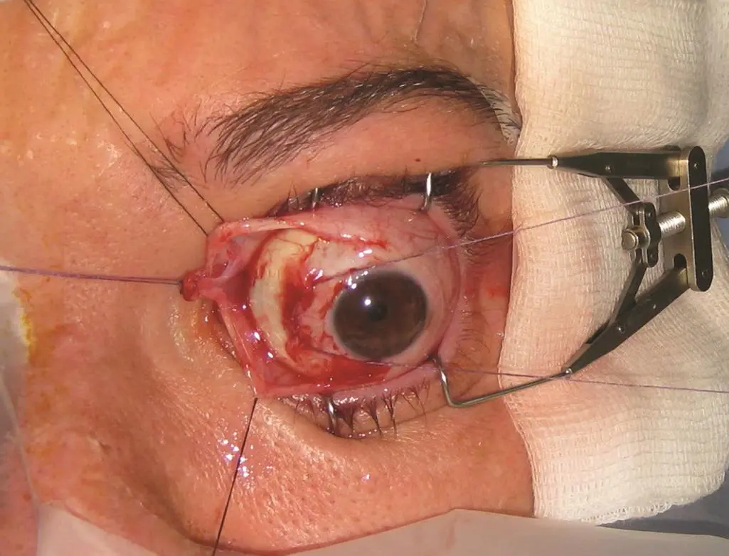Orbitotomy American Academy Of Ophthalmology